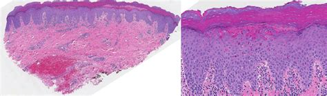 A Superficial Peri­ Vascular Dermatitis With M I L D P A P I L L A R Y