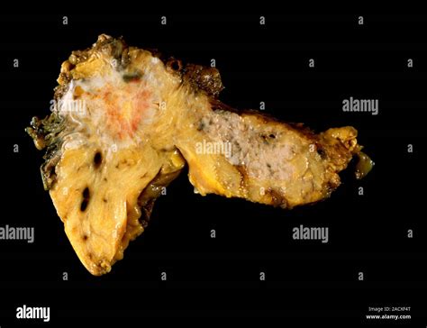 Pancreatic Cancer Gross Specimen Large Malignant Cancerous Tumours