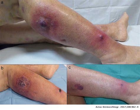 Gangrenous Pyoderma What Is It Symptoms Treatment Prognosis