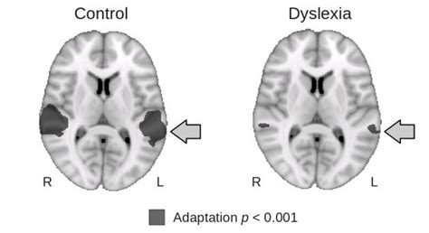 Extensive Neural Adaptation Revealed Strong Talker Normalization Download Scientific Diagram