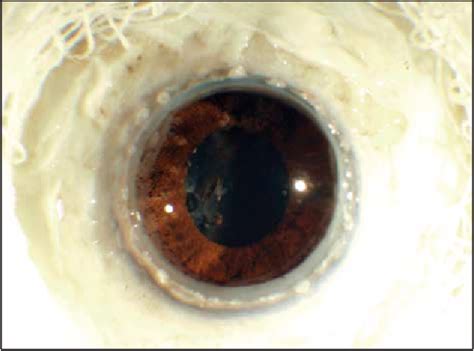 Figure 3 From A Practice Model For Trabecular Meshwork Surgery