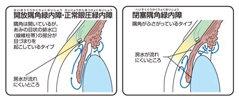 緑内障 川口市 新井宿・戸塚安行の白内障・緑内障手術棟併設の鳩ヶ谷きどぐち眼科