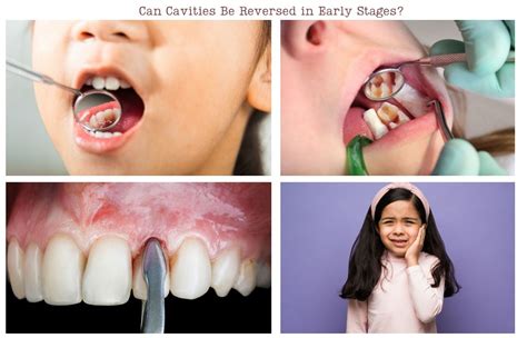 Can Cavities Be Reversed In Early Stages Know More