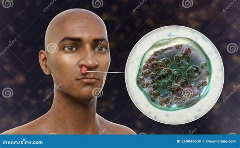 Nasal Rhinosporidiosis In A Patient 3d Illustration A Disease Caused