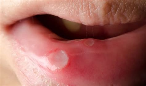Mouth Ulcer What It Looks Like Causes And When To See A Dentist Newmouth