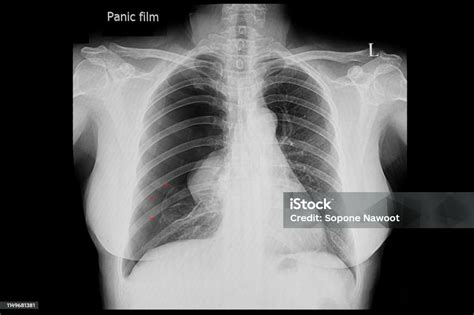 Pneumothorax Lung X Ray