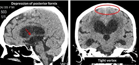 Normal Pressure Hydrocephalus Radiology Cases