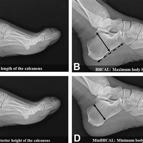 Lateral View Measurements Of The Calcaneus Download Scientific Diagram