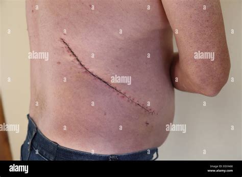 Scar With Staples Following A Partial Nephrectomy Operation On Right