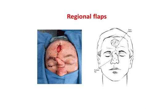 Types Of Flap Pptx