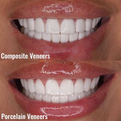 Porcelain Vs Composite Veneers 7 Shocking Differences