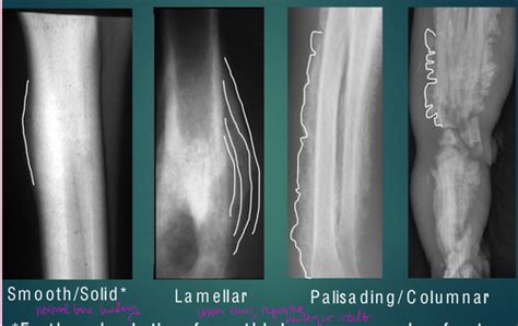 Musculoskeletal Radiology Aggressive Vs Benign Lesions Flashcards