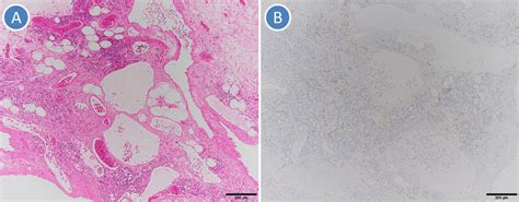Pathology A The Lesion Is Composed Of Dilated Lymphatic Vessels Hande