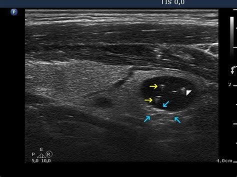 Selected Topics Intranodular Hyperechogenic Figures