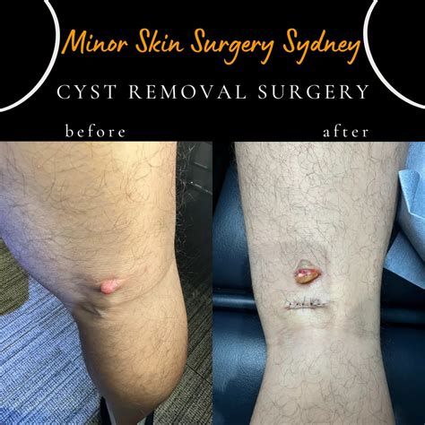 Cyst Surgery Cyst Removal Cyst Treatment Sydney