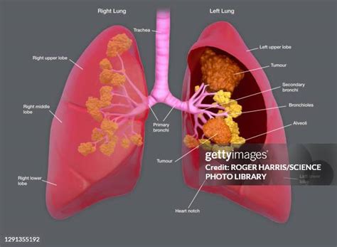Lung Cancer Cells Diagram