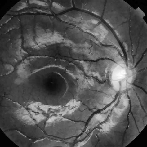 Retinal Disease Identifier