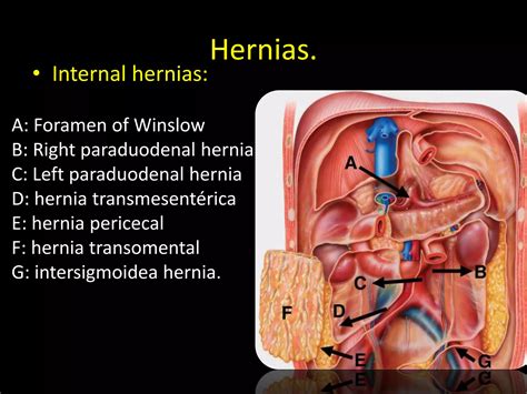 Hernias Ingl Pptx