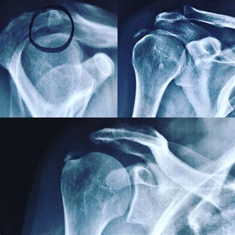Tendinitis Calcificada Guatemala Sportclinic Guatemala