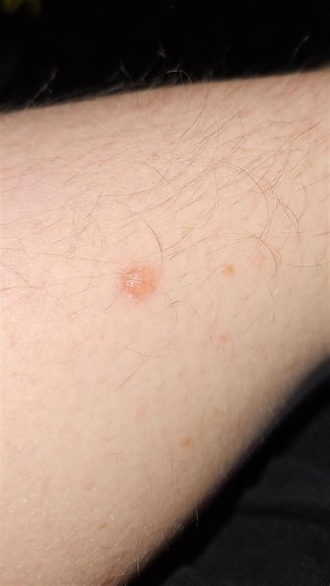 Does This Mole Look Normal Rmelanoma