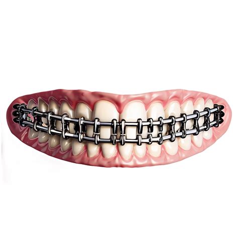 Download Mouth With Braces Png Gpa67