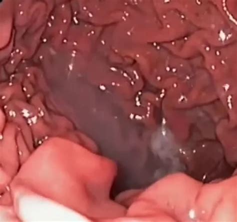 Endoscope Stomach Giantess Vore Full Tour Thisvid Com