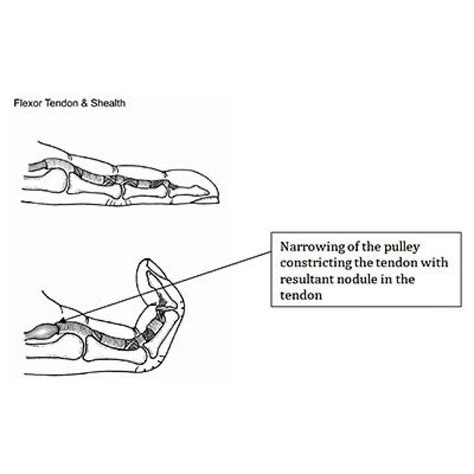 Trigger Finger Treatment Surgery Hand Surgery Associates