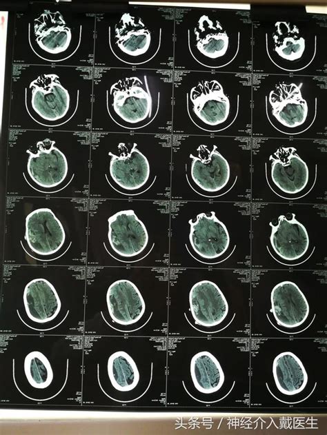 血肿机化图片jo化图片大山谷图库