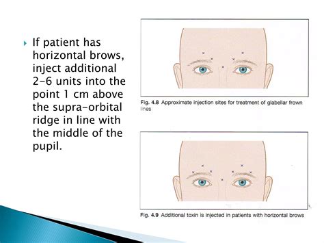 Botox Training Pdf