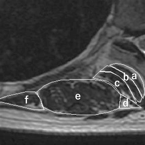 Posterior Extensor Muscles Visualized On An Axial T2 Weighted Image