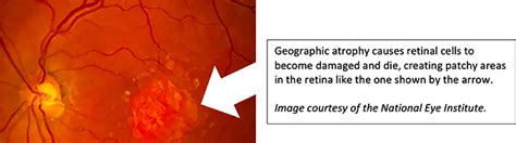 Geographic Atrophy Care In The Charleston Sc Area