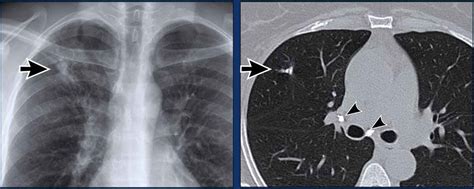 The Radiology Assistant Imaging Findings In Tb