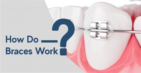 How Do Braces Work Stephenson Orthodontics Blog