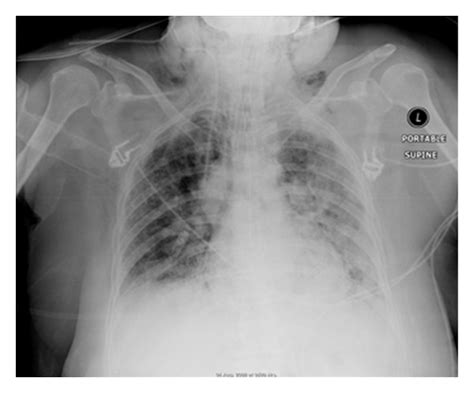 A Cxr Showing A Pneumothorax Following Insertion Of An Intravenous Line