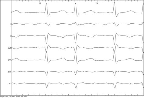 On Electrocardiogram An Atrial Flutter Is Registered F Waves Negative
