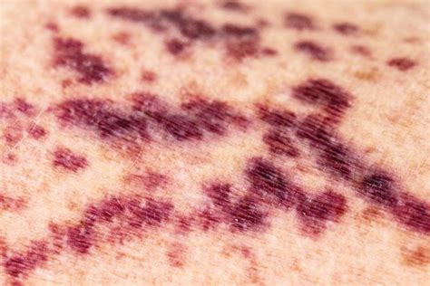 Purpuric Rash Leg Symptoms Images Treatments