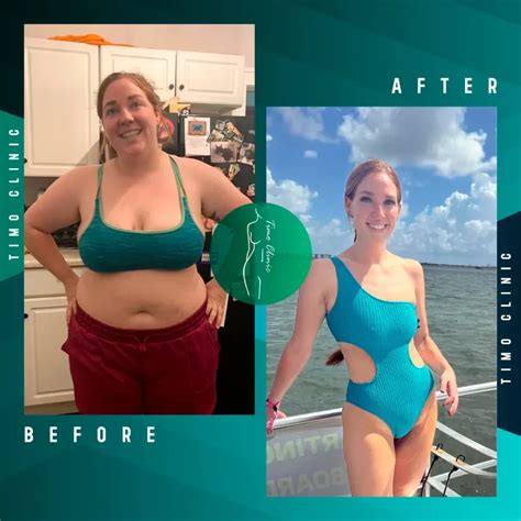 Weight Loss Gallery Timo Clinic Turkey