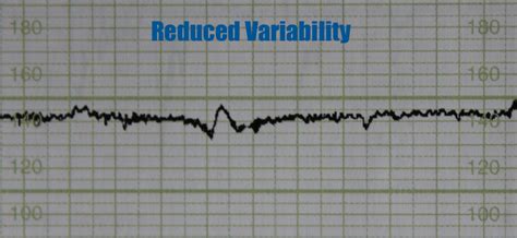 How To Read A Ctg Faculty Of Medicine