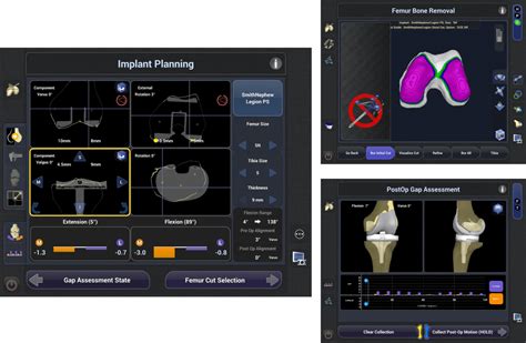 Robotic Knee Replacement Surgery Guide Dr Shiva Reddy