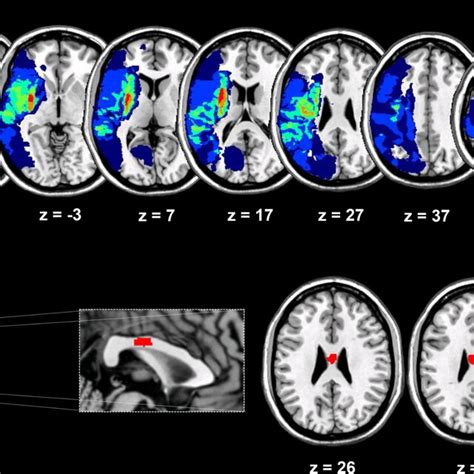 Local And Global Transcranial Magnetic Stimulation Tms‐evoked Download Scientific Diagram