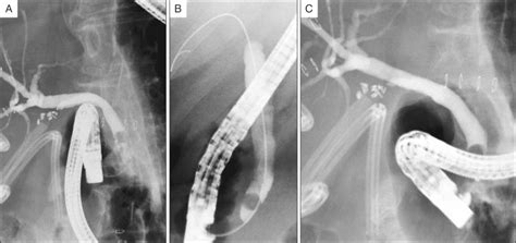 Stone Extraction Clinical Tree