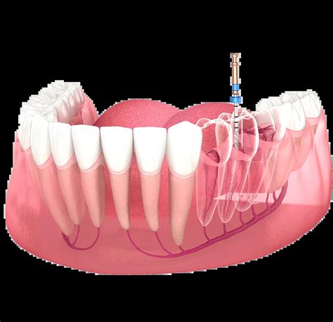 Kanal Tedavisi Dt Bülent Kenir Diş Hekimi Kuşadası Diş Kliniği