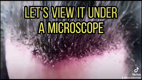 Lice Under The Microscope Kuto Liceinfestation Youtube
