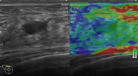 Breast And Axilla 54 Elastography Case 541 Elastography Benign