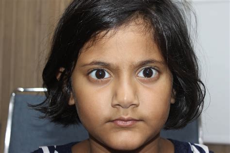 Full Recovery In Case Of Abcd Airborne Contact Dermatitis And