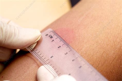 Ppd Test Measurement