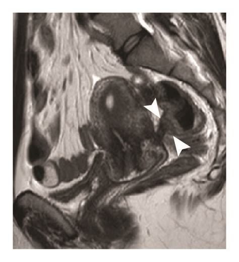 29 Year Old Woman With Dpe And Infiltrative Nodule Requiring