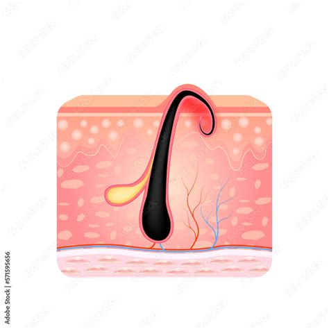 Ingrown Hair Hair Has Grown Back Into The Skin Surface After Shaving