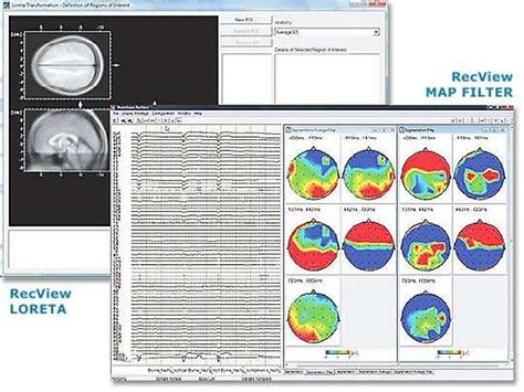 Quantitative Electroencephalogram Qeeg Montreal Neurotherapy Center