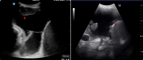 Malignant Pleural Effusion A Multidisciplinary Approach Open